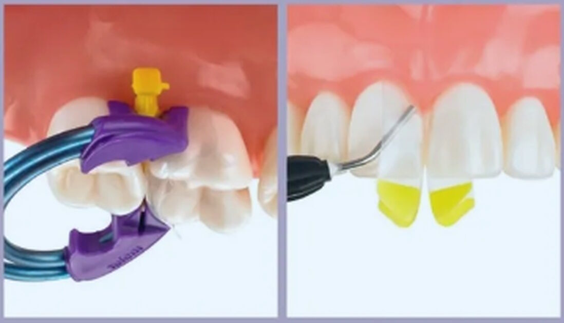 Burgess Dental Training for Bioclear Matrix Composite Bonding Courses